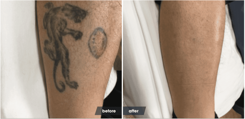 The Laser Tattoo Removal Healing Process | Removery