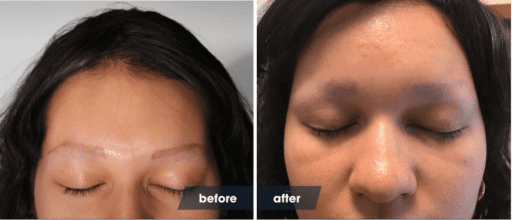 How to Remove Microblading | Removery