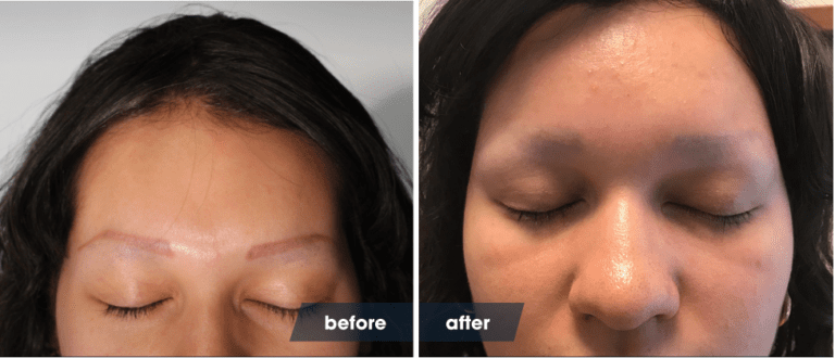 How to Remove Microblading | Removery