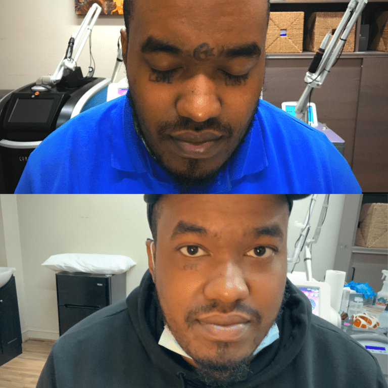 Face Tattoo Removal Services | Removery