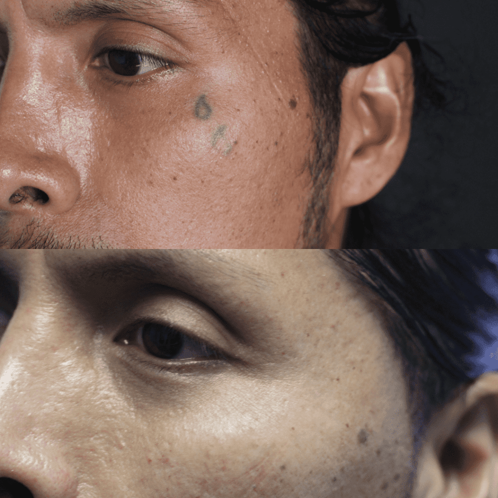 Face Tattoo Removal Services | Removery