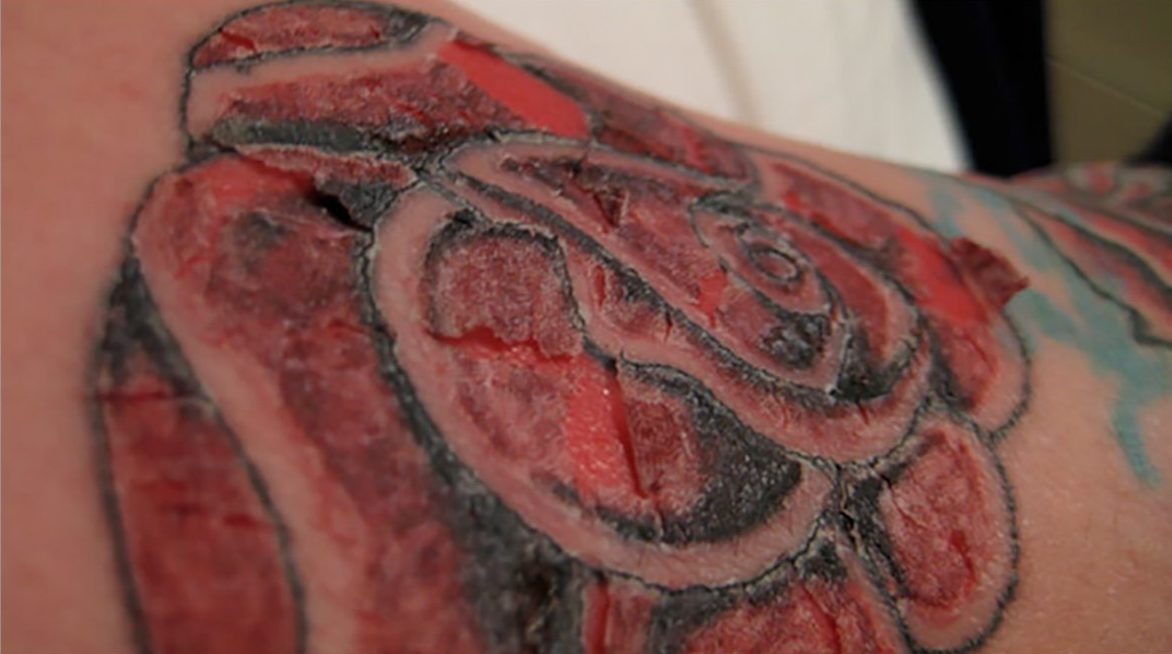 29 Tattoo Bubbling Vs Infection EyaadFahrhed