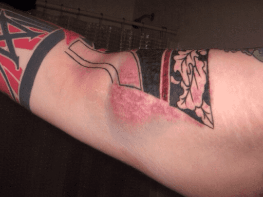 Infected Tattoo Stages: Signs of Infection from Tattoos and After ...